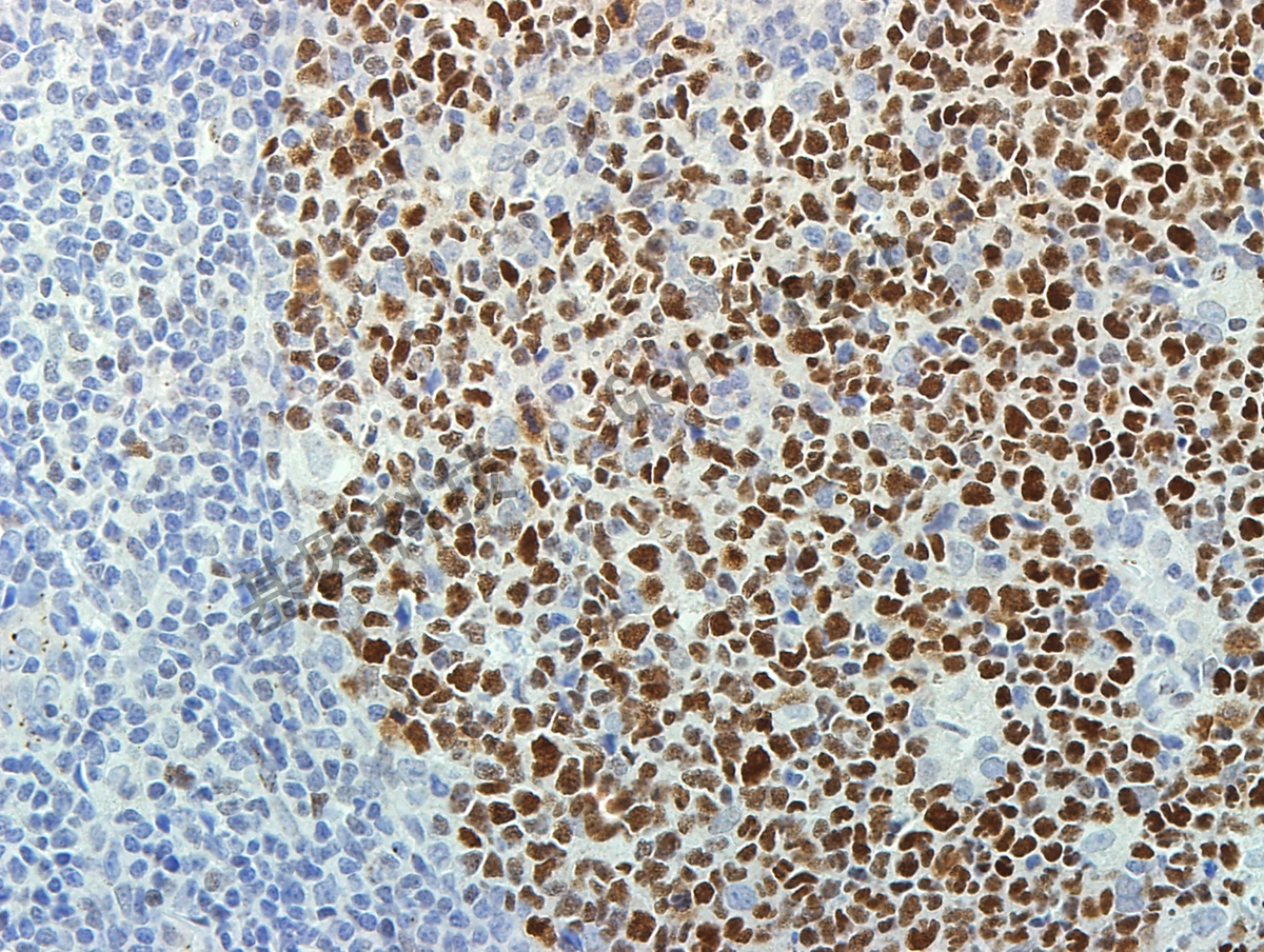 Bcl-6 鼠抗人 bcl-6 抗体试剂（免疫组织化学）