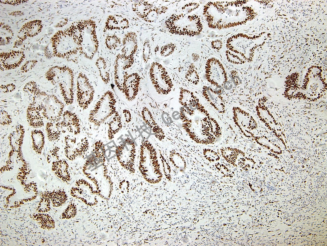 MSH6 兔抗人 MSH6 抗体试剂（免疫组织化学）
