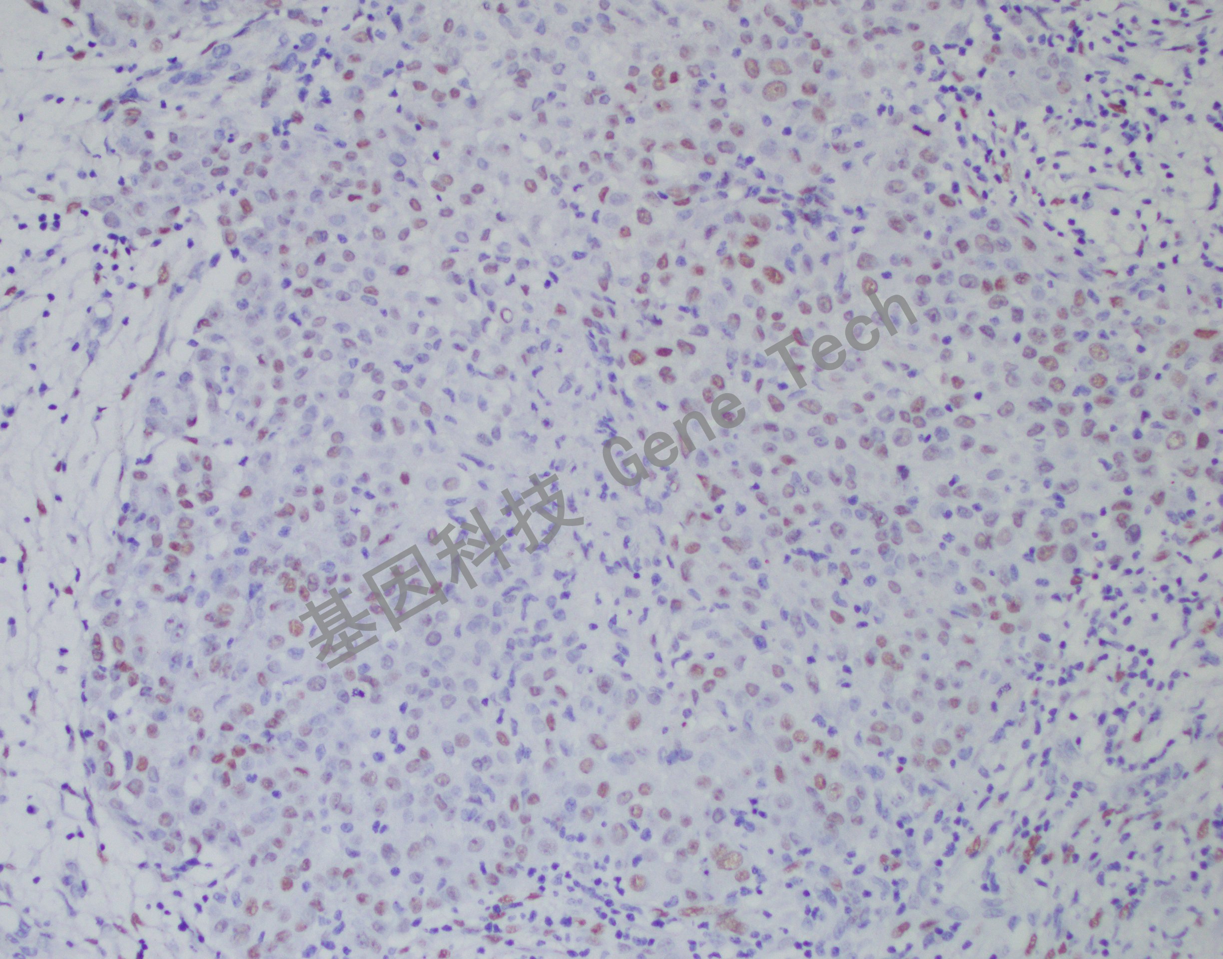 WT1 兔抗人 WT1 抗体试剂（免疫组织化学）