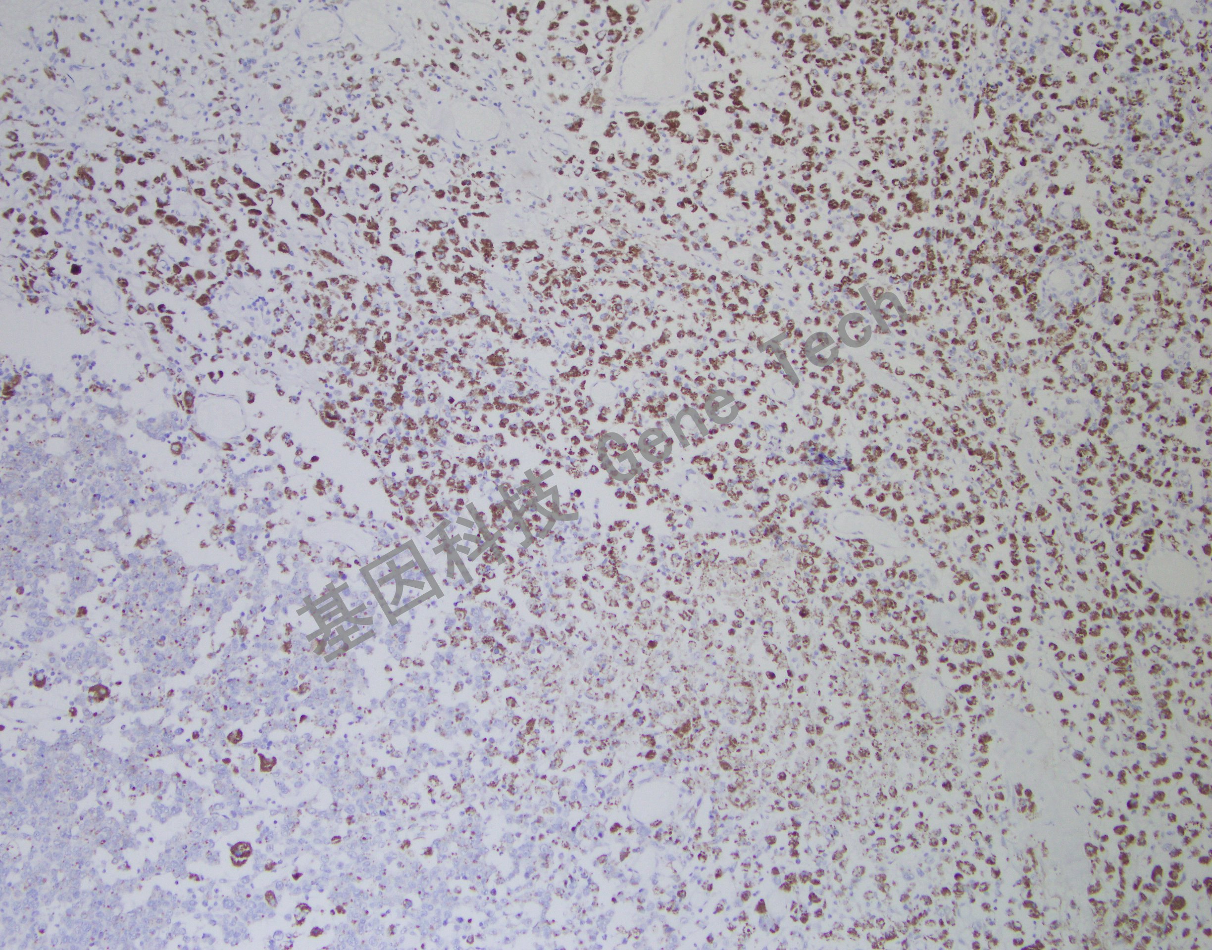 WT1 兔抗人 WT1 抗体试剂（免疫组织化学）