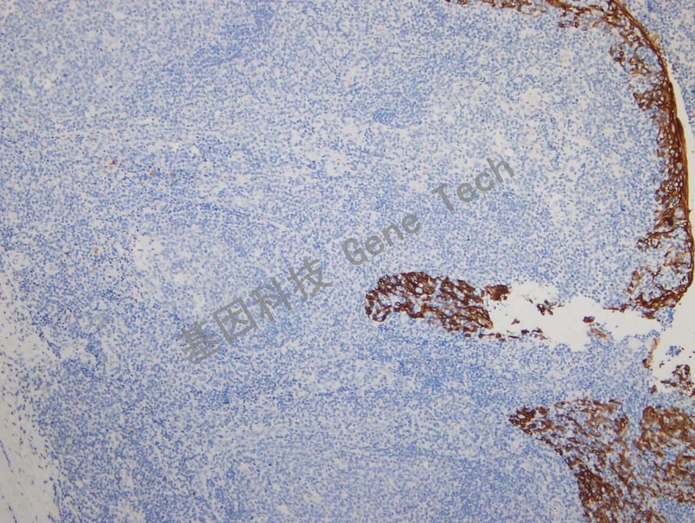 CK，Pan 鼠抗人 细胞角蛋白（广谱）抗体试剂（免疫组织化学）